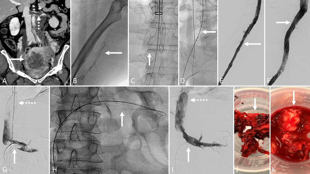 Simplifying Complex DVT Thrombectomy Cases | VDM